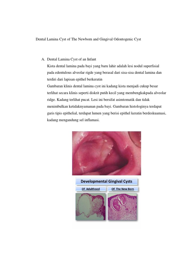 Dental Lamina Cyst of the Newborn and Gingival Odontogenic Cyst