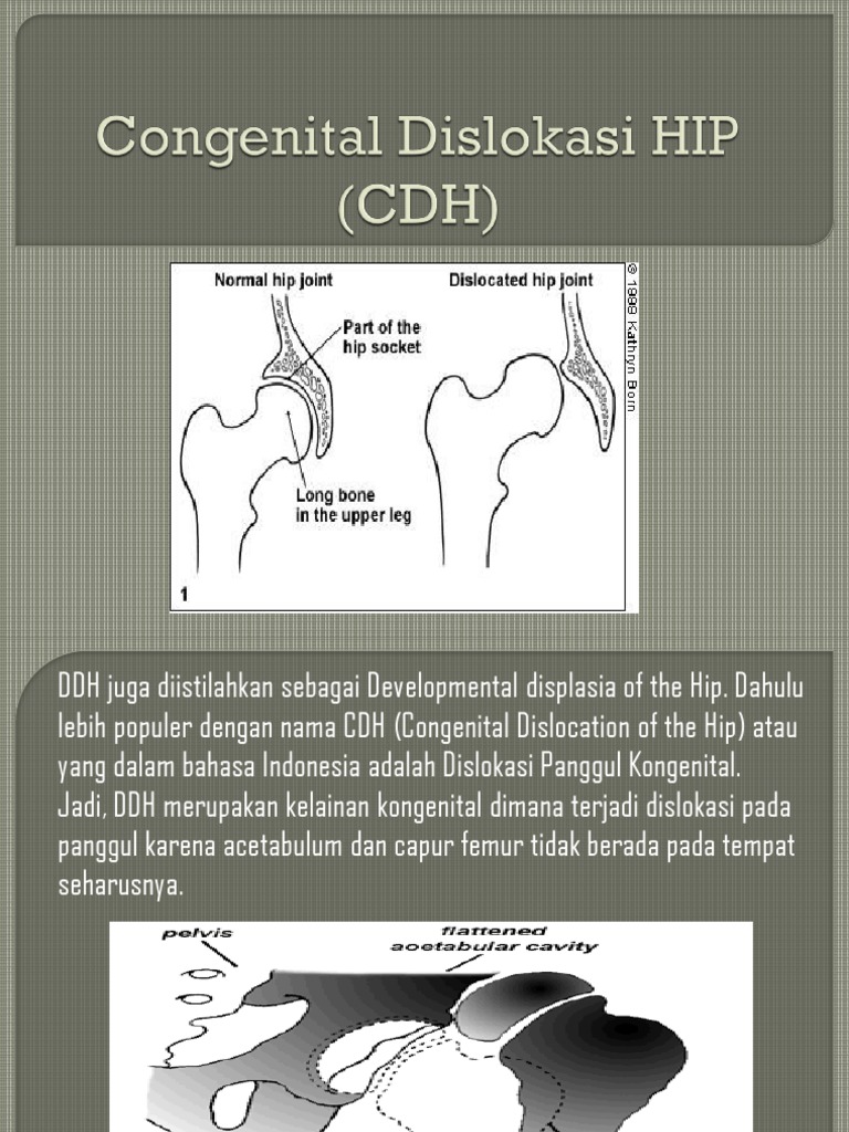 Congenital Dislokasi HIP (CDH) | PDF