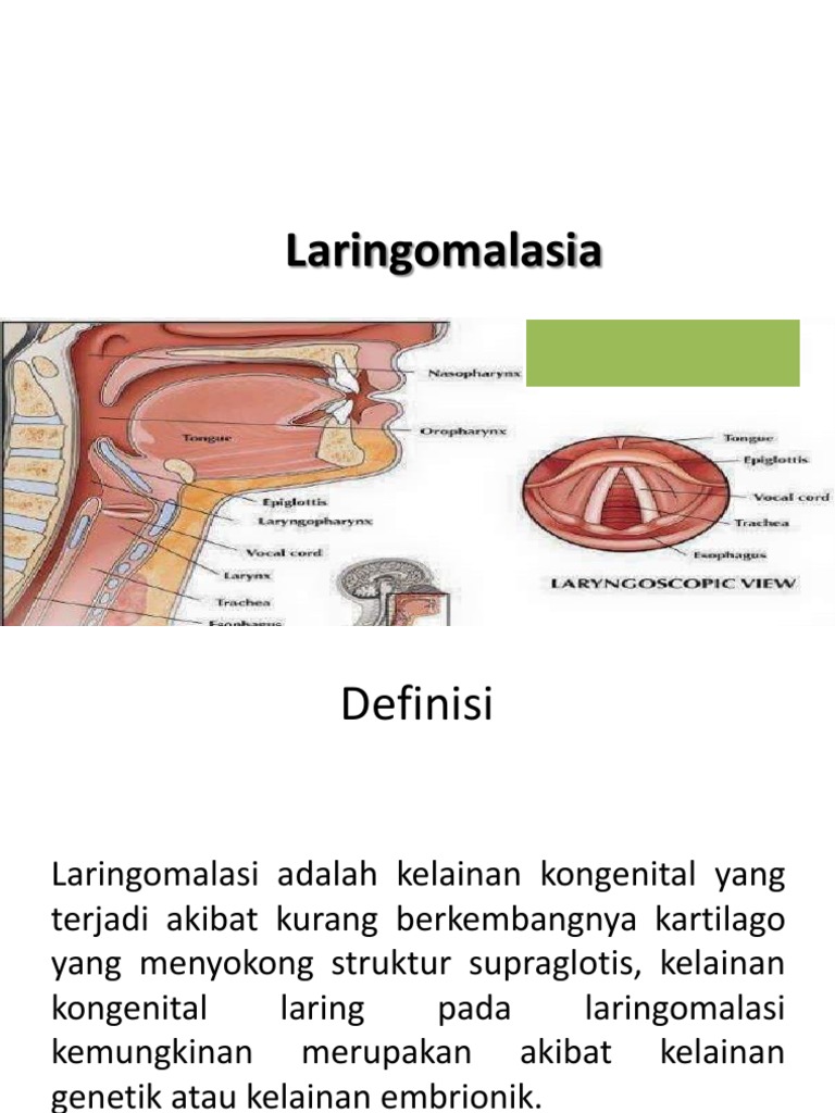 Laringomalasia | PDF