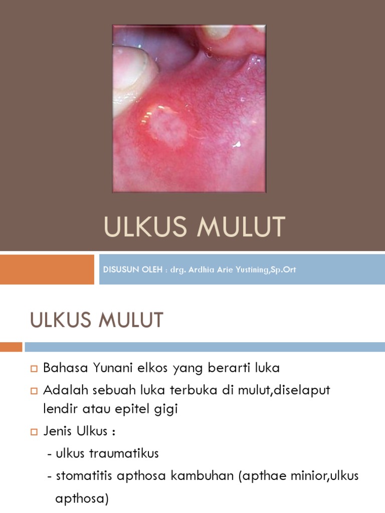 Ulkus Mulut | PDF