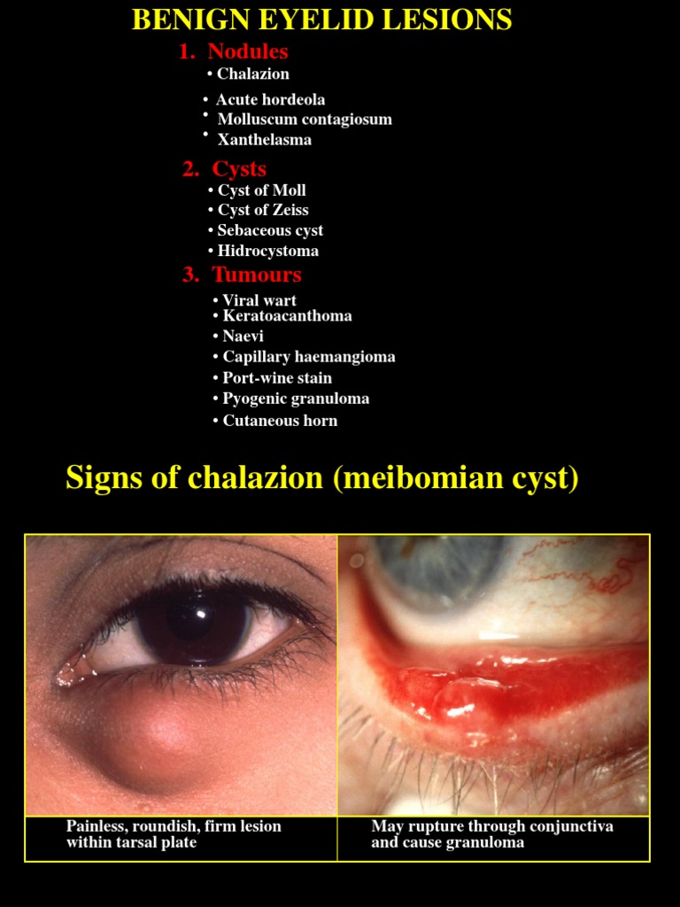 Nodules: - Chalazion - Acute Hordeola | PDF | Epidermis | Skin