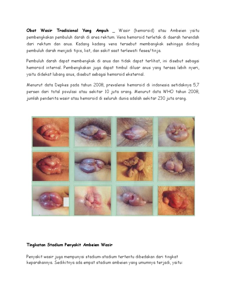 Obat Wasir Tradisional Yang Ampuh | PDF | Sains & Matematika | Gaya Hidup
