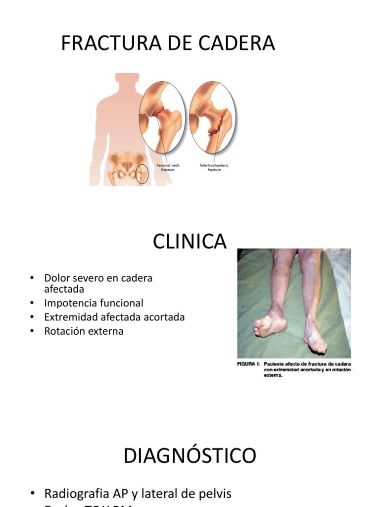 Fractura de cadera | Cadera | Sistema esquelético