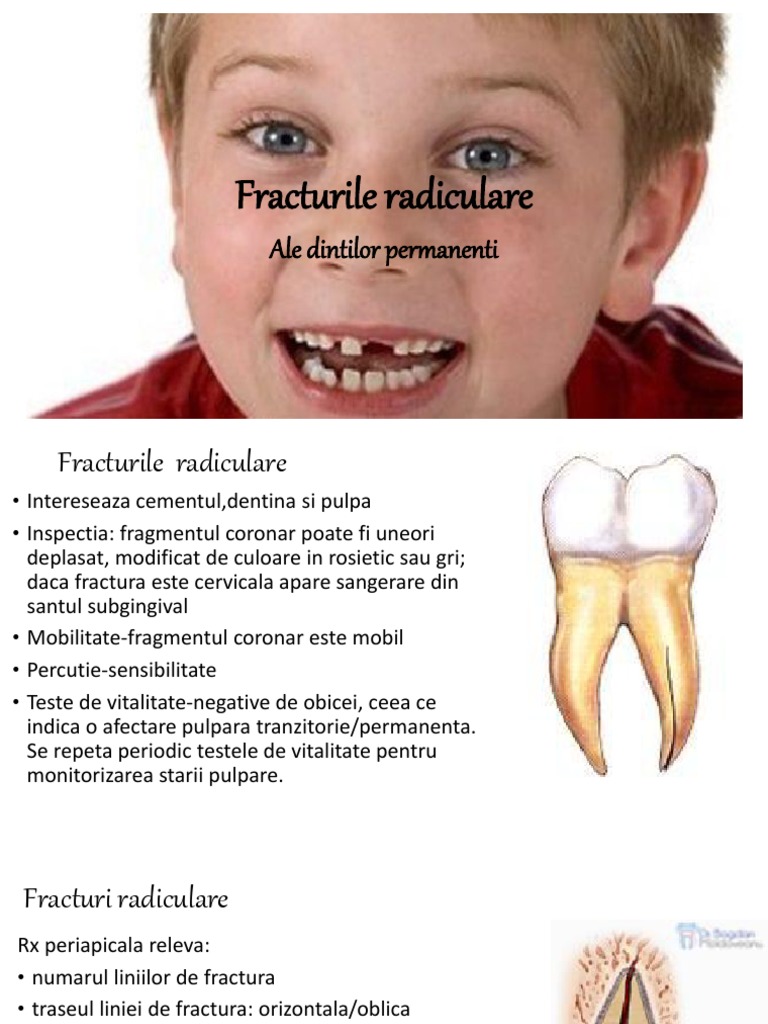 Fracturi Radiculare | PDF