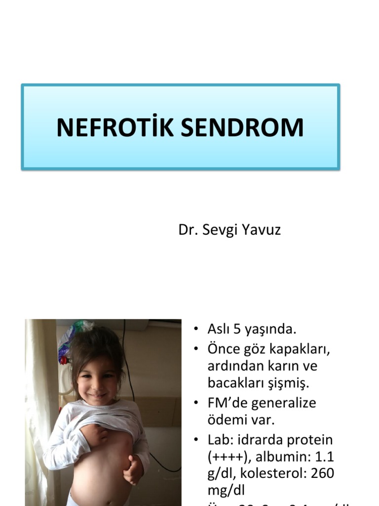 Nefrotik Sendrom | PDF