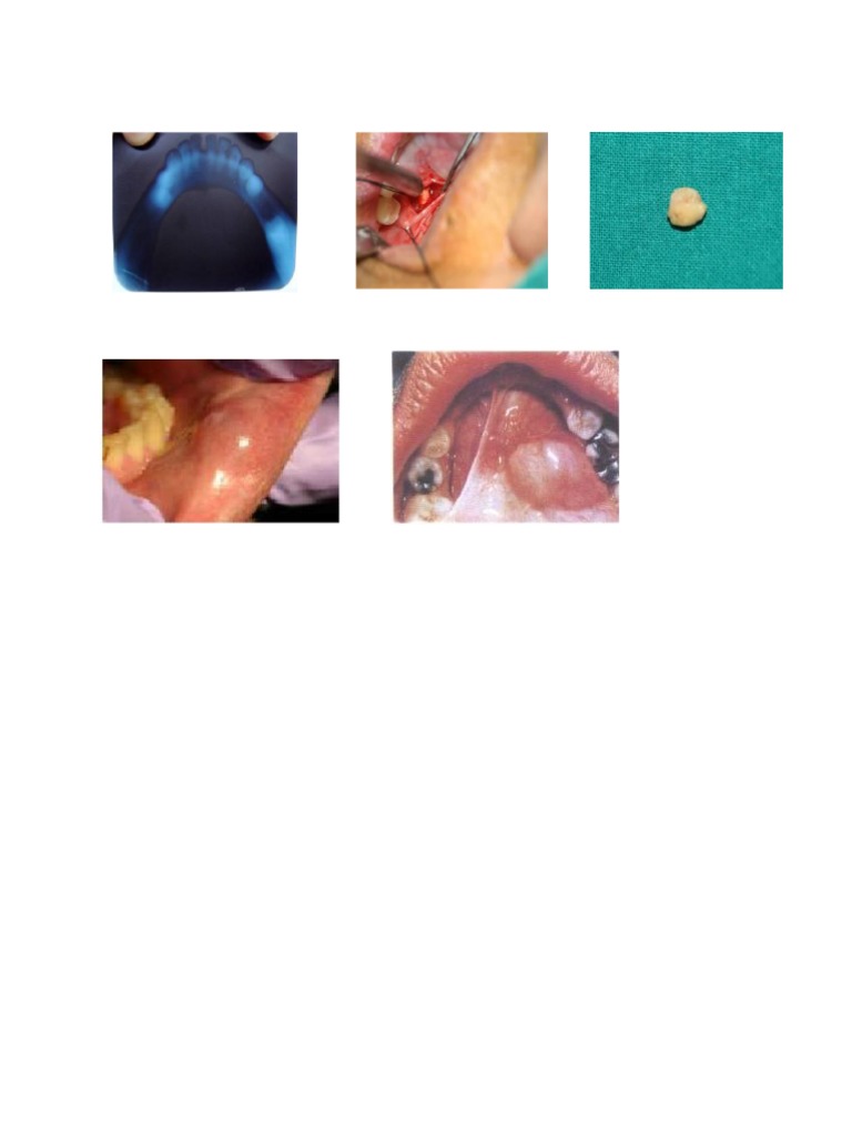 Gambar Ranula Dan Mucocele | PDF