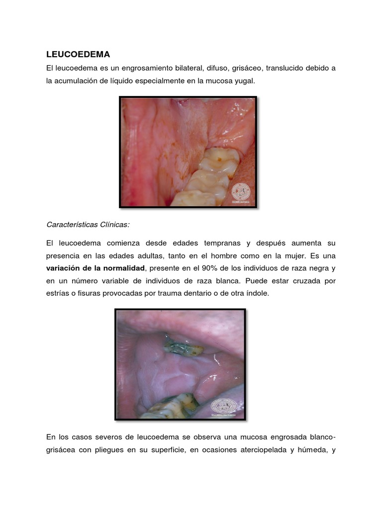 Leucoedema: Características y Tratamiento | PDF | Membrana mucosa ...