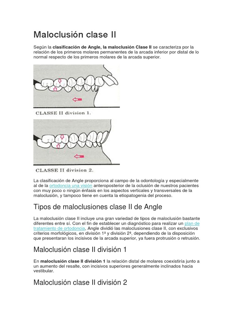 Maloclusión Clase II: Divisiones 1 y 2 | PDF | Ciencia y matemáticas