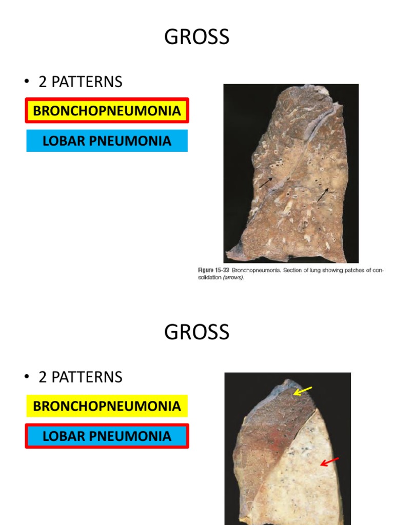 GROSS - Broncho & Lobar Pneumonia | PDF