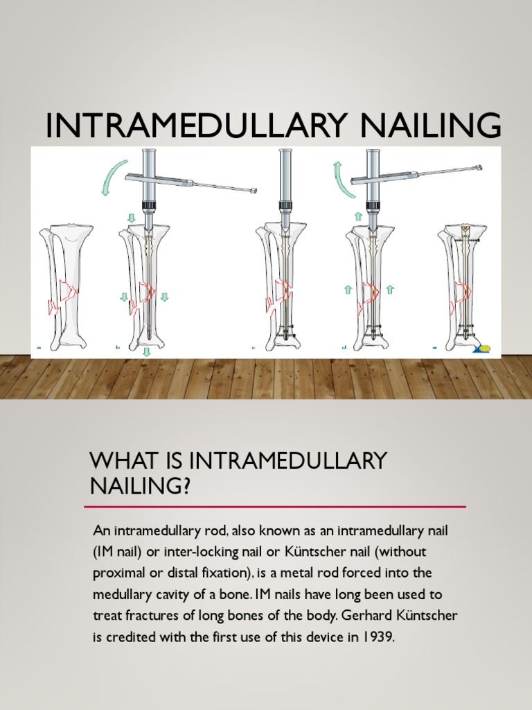IM Nailing | PDF | Surgery | Wound