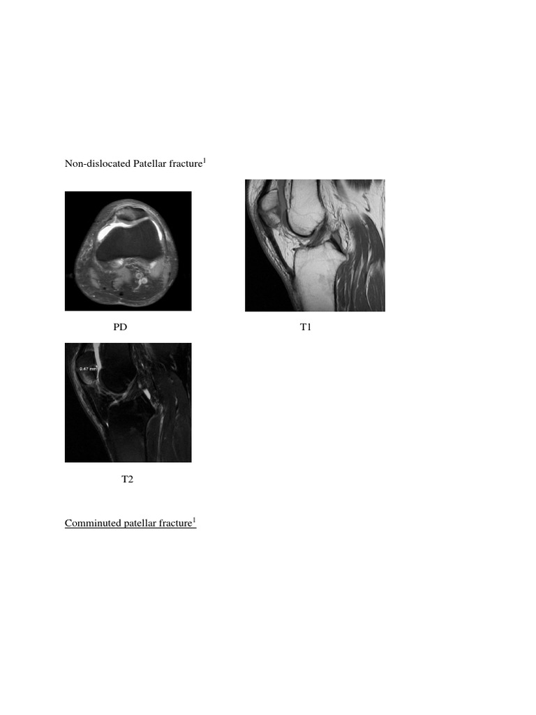 Mri Patella Fracture | PDF