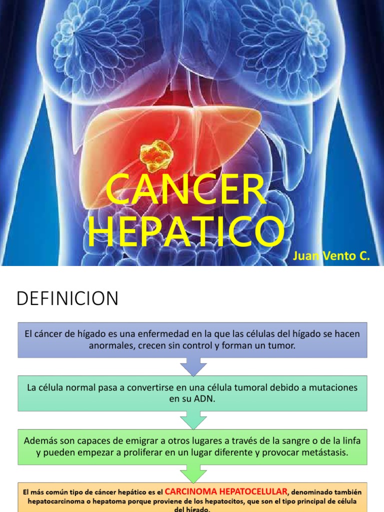 Cancer Hepatico Revision | Metástasis | Cáncer
