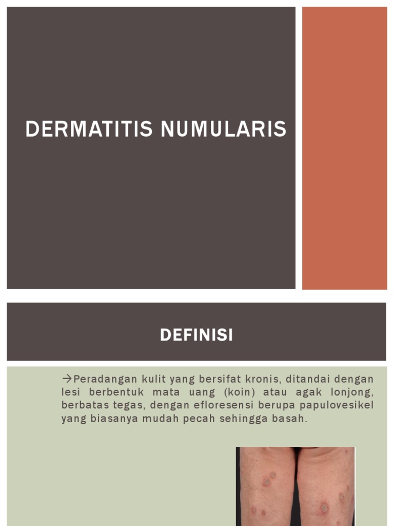 Dermatitis Numularis | PDF