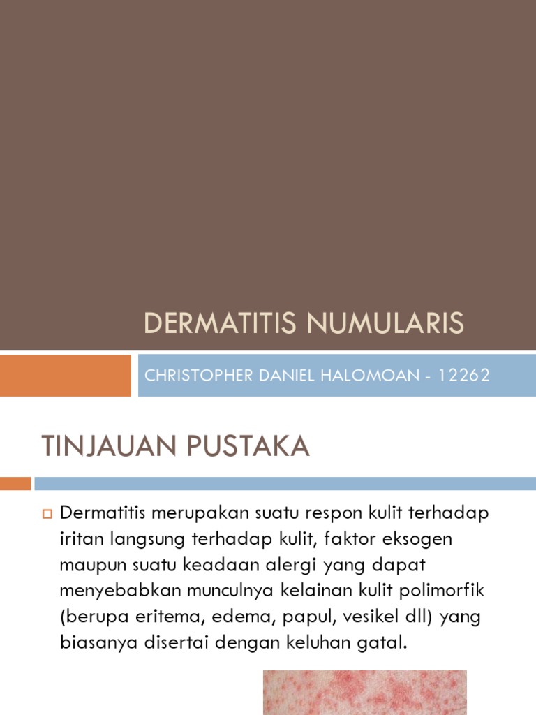 Dermatitis Numularis | PDF | Kesehatan Holistik | Sains & Matematika