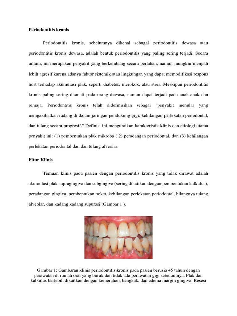 Periodontitis Kronis | PDF