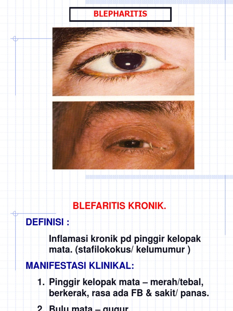 Blepharitis | PDF