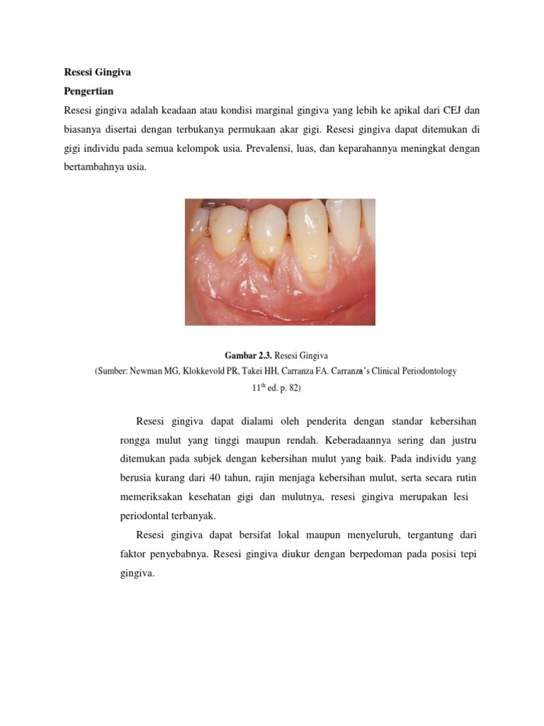 Resesi Gingiva | PDF