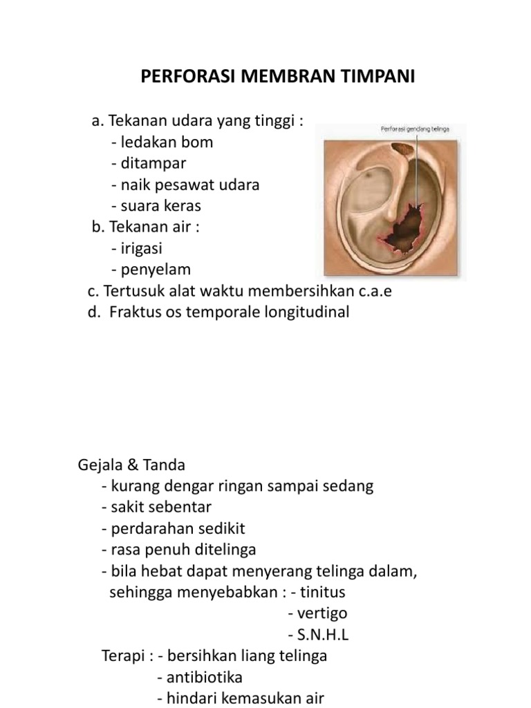 Perforasi Membran Timpani dan Tatalaksana | PDF