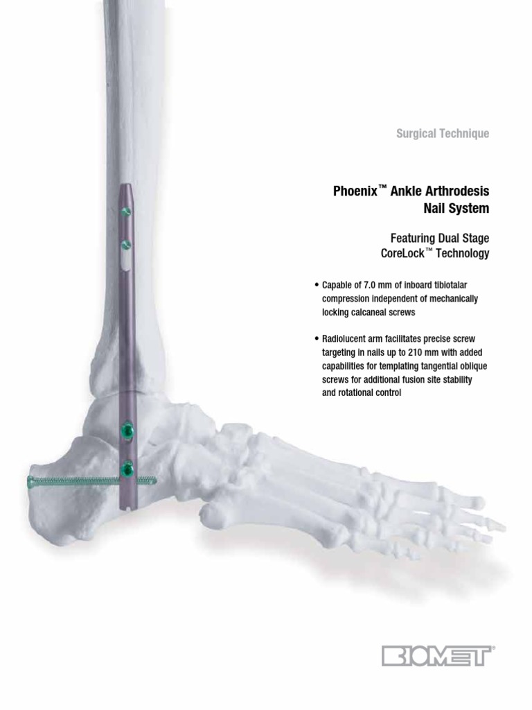 Phoenix Ankle Arthrodesis Nail System Surgical Technique PDF | PDF ...