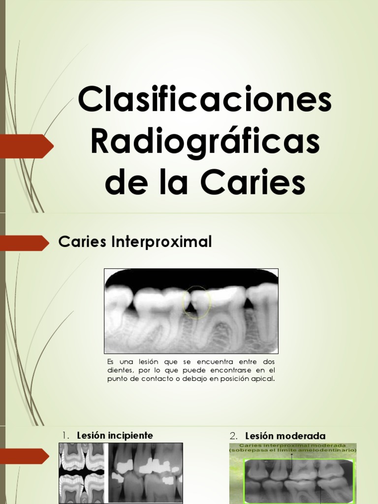 Clasificacion Radiografica de Las Caries 15-06-2016 | Diente | Esmalte ...