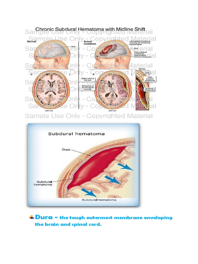 Dura - : The Tough Outermost Membrane Enveloping The Brain and Spinal ...