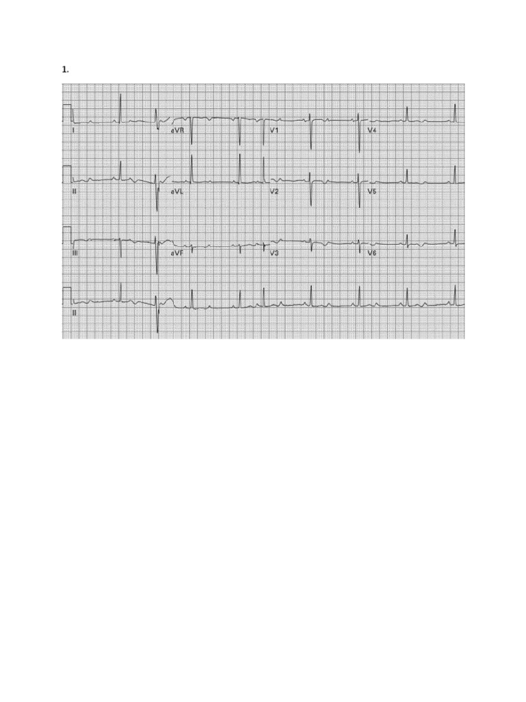 Analisis EKG: Sinus Takikardia dan Aritmia | PDF