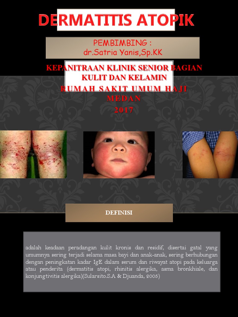 Dermatitis Atopik | PDF