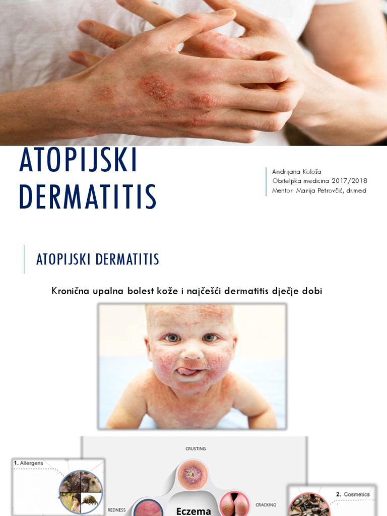 Atopijski Dermatitis | PDF