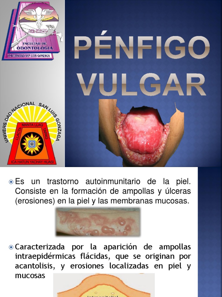Pénfigo Vulgar | PDF | Ciencias de la Salud | Medicina CLINICA