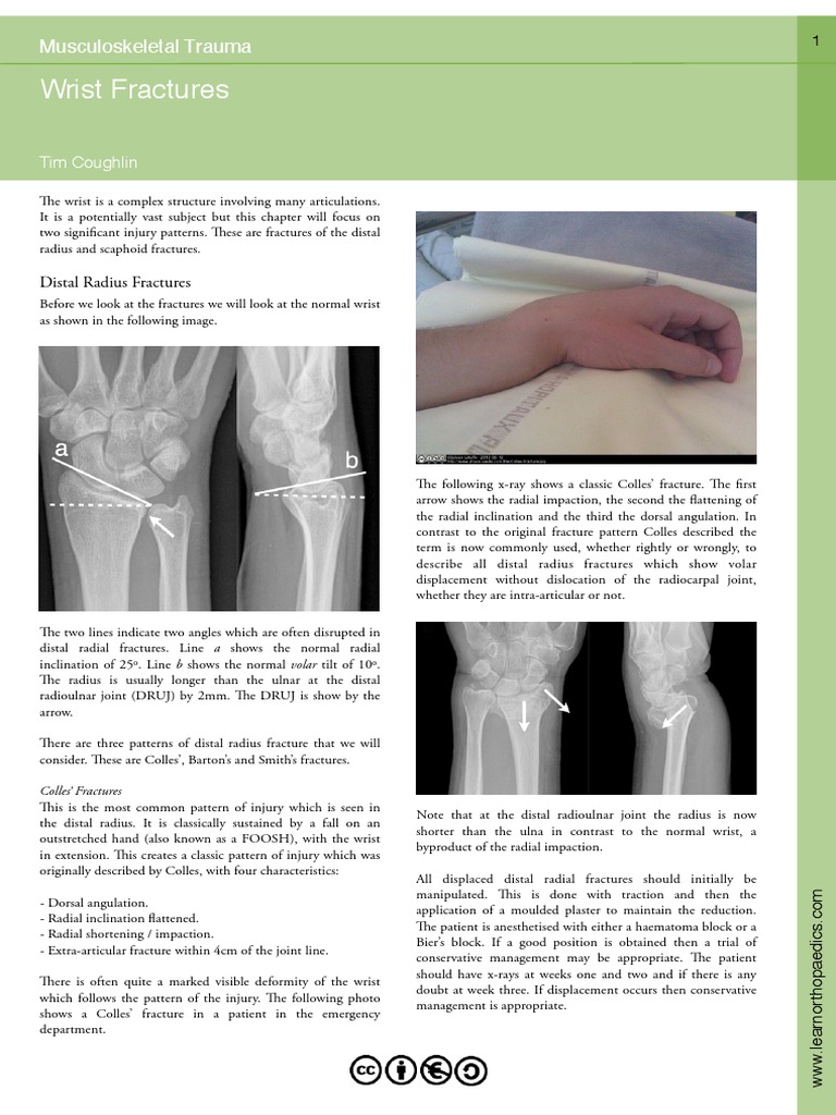Wrist Fractures | PDF | Skeletal System | Limbs (Anatomy)
