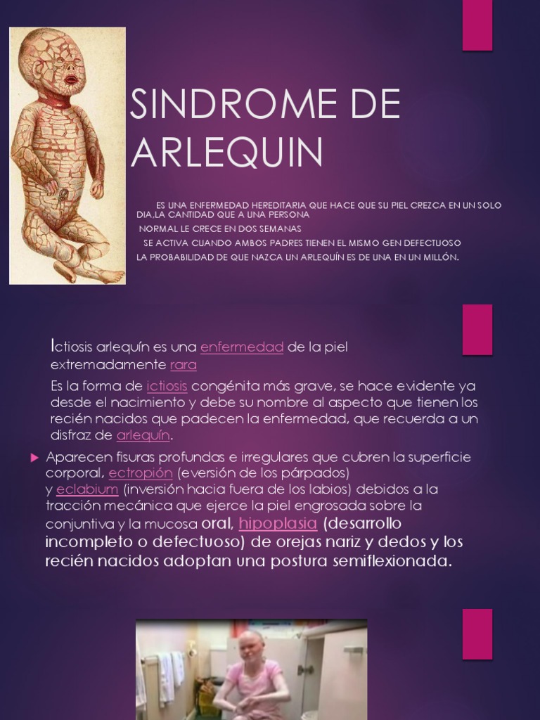 Sindrome de Arlequin