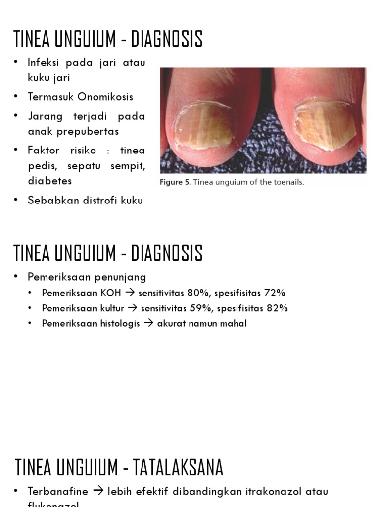 Tinea Unguium | PDF