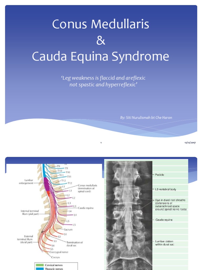 Ortho Conus Medullaris and Cauda Equina Syndrome | PDF | Nervous System ...