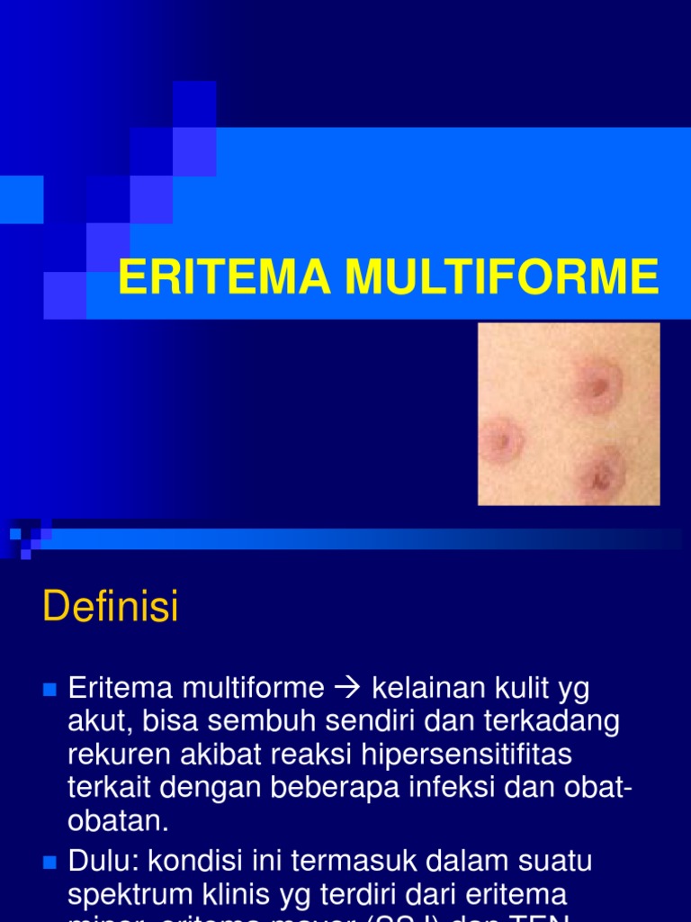 Eritema Multiforme | PDF