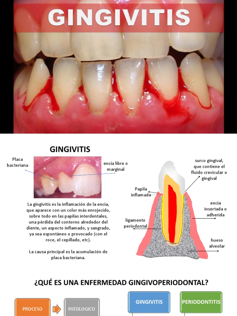 Gingivitis | PDF | Ramas de Odontología | Enfermedades y trastornos