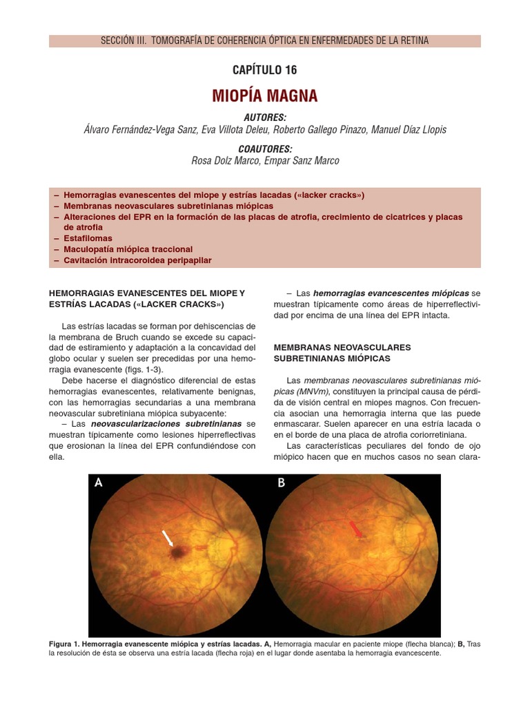 CAPÍTULO 16 MIOPÍA MAGNA | PDF | Ojo humano | Retina
