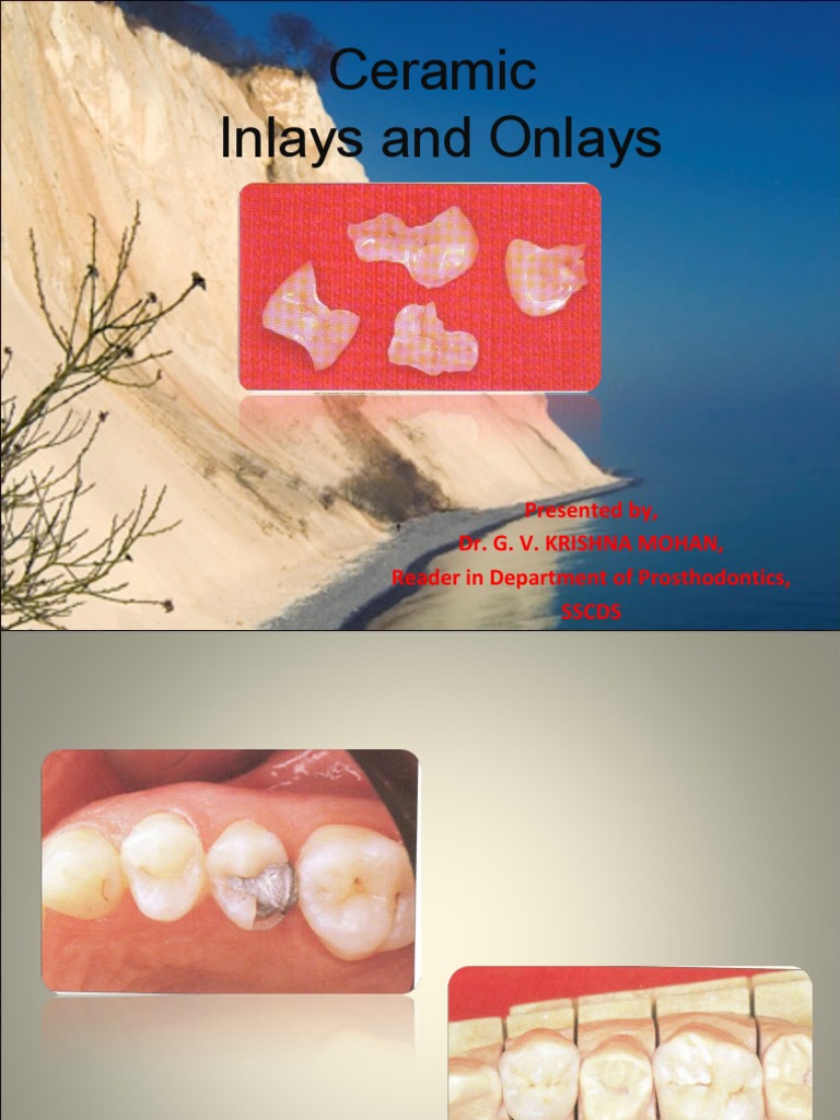 Ceramic Inlays and Onlays: Presented By, Dr. G. V. Krishna Mohan ...