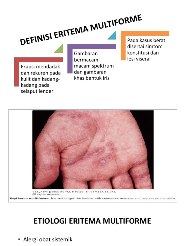 Eritema Multiforme | PDF