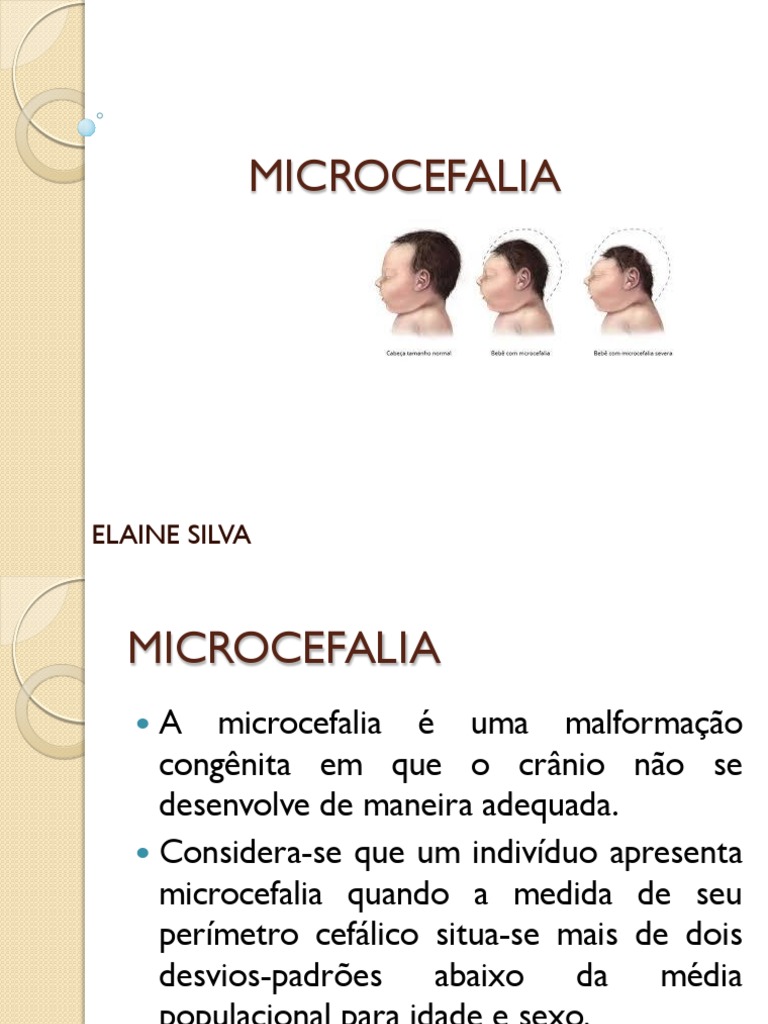 Microcefalia | PDF | Transtorno congênito | Gravidez