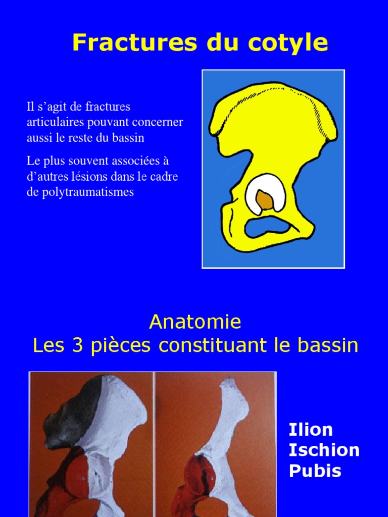 04- Fractures Du Cotyle