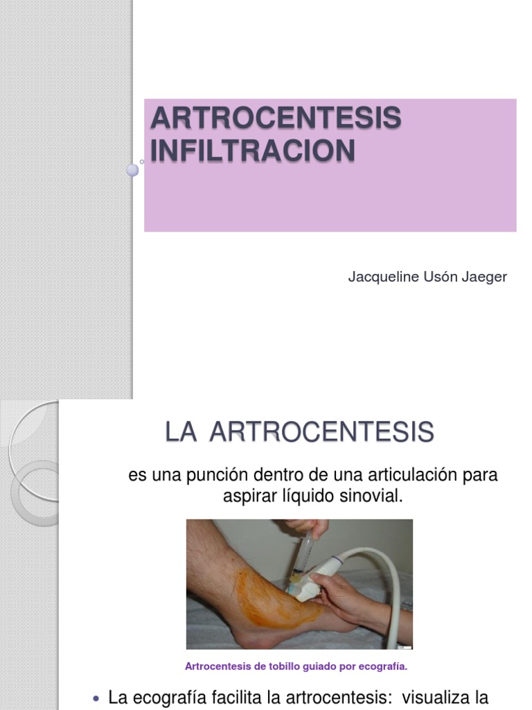 Artrocentesis e Infiltracion | PDF | Artritis | Inflamación
