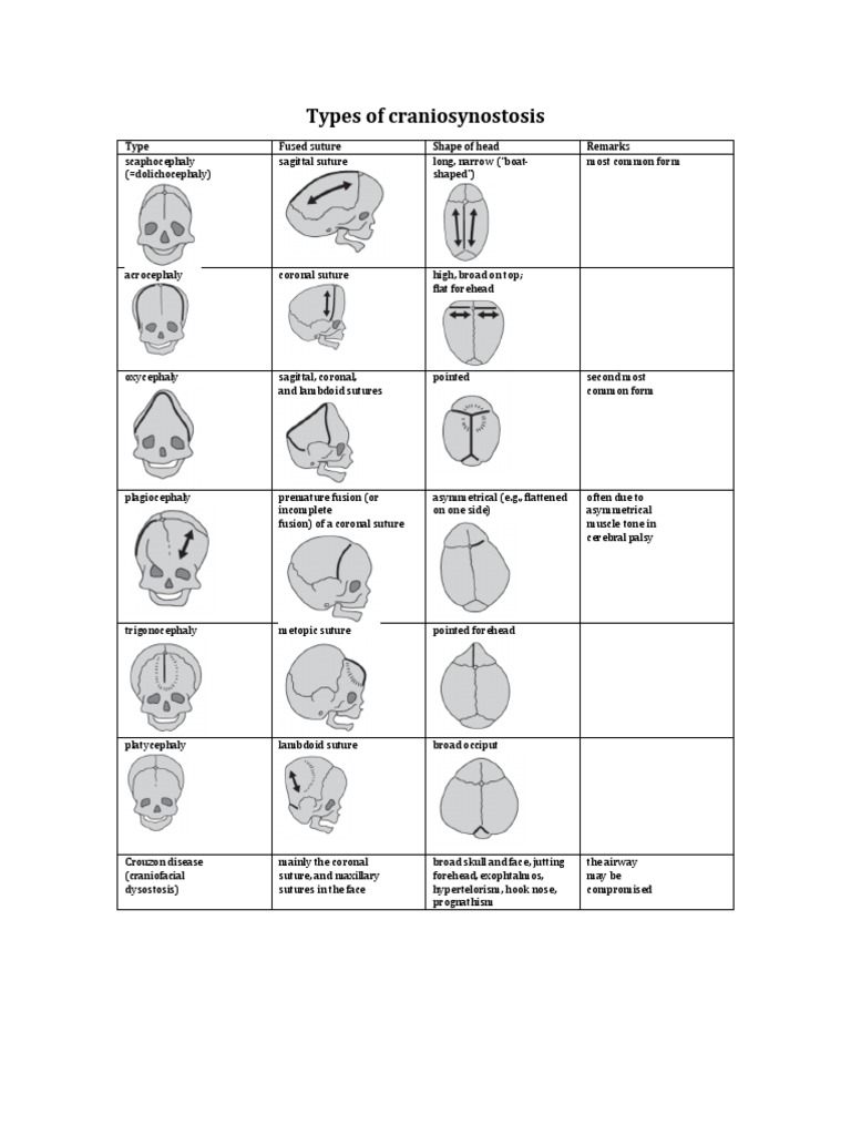 Types of Craniosynostosis: Type Fused Suture Shape of Head Remarks ...