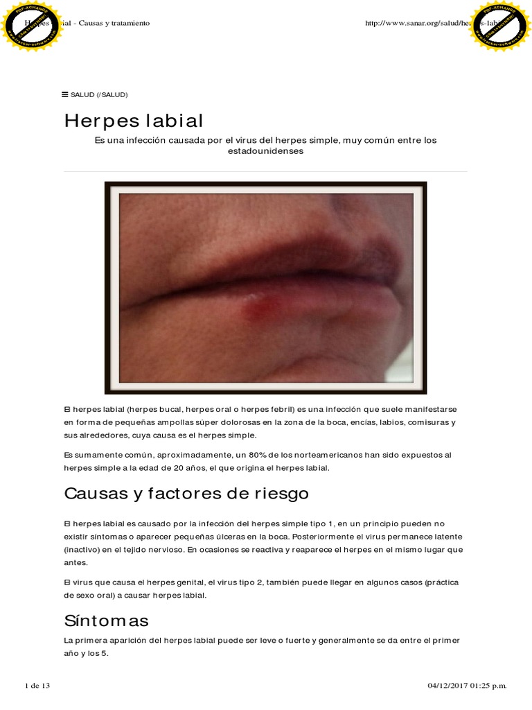 Herpes Labial - Causas y Tratamiento | PDF | Herpes Simple | Enfermedades virales