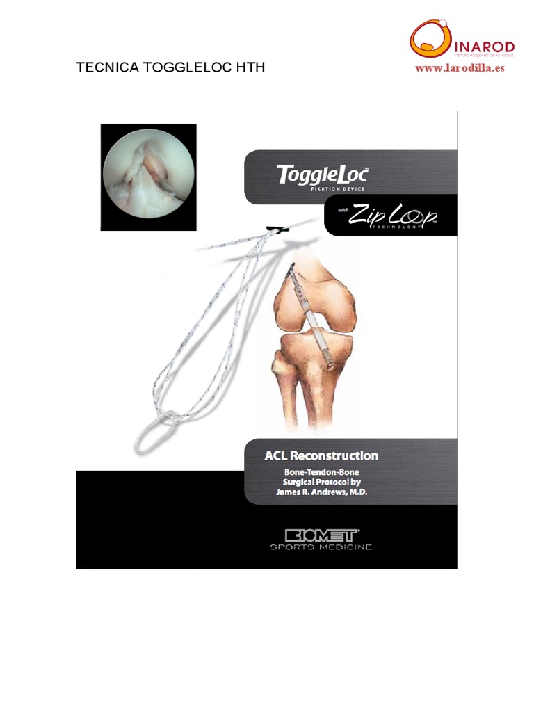 Lca HTH Toggleloc | PDF | Extremidades (anatomía) | Anatomía del ...