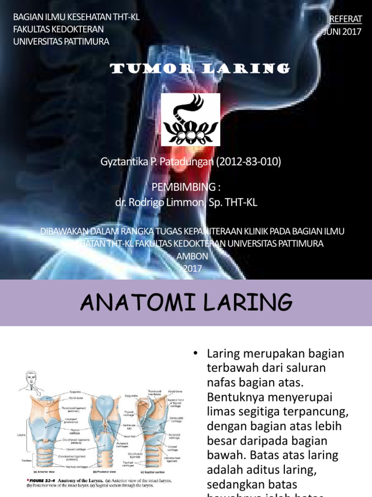 Tumor Laring | PDF