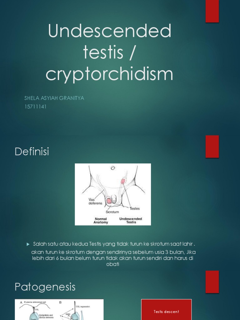 3.1 Undescended Testis | PDF