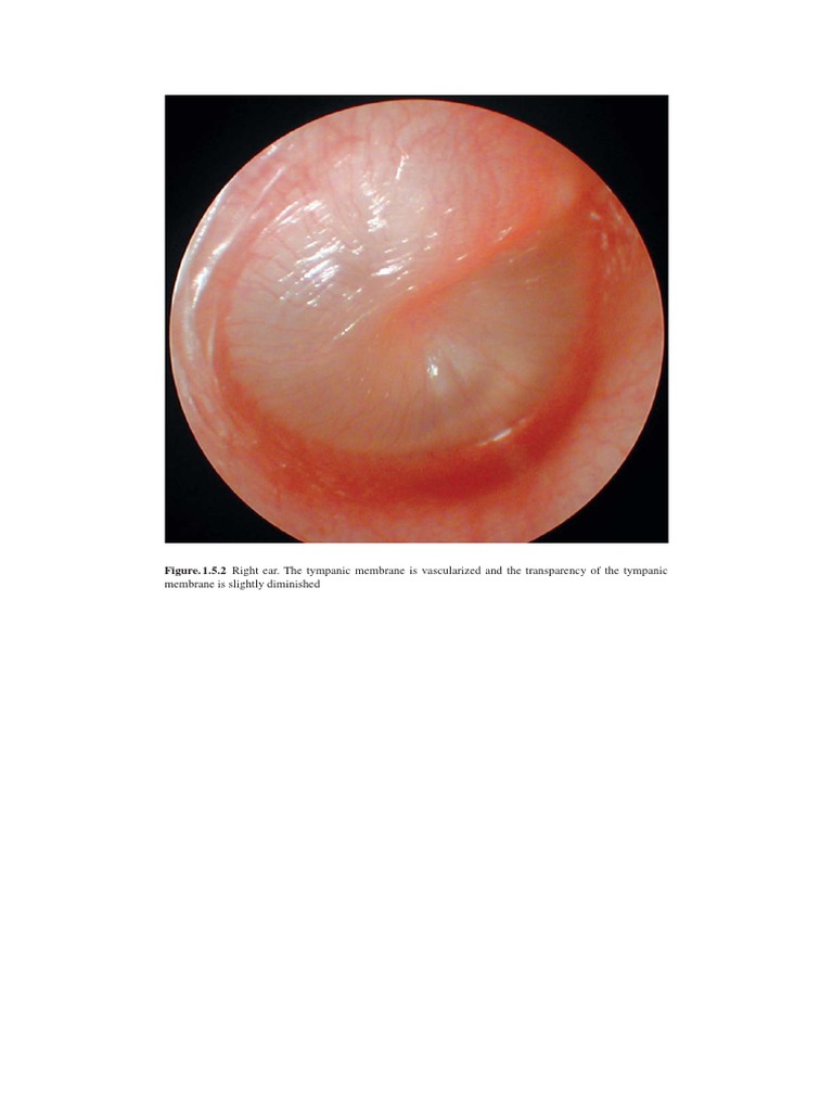 Figure. 1.5.2 Right Ear. The Tympanic Membrane Is Vascularized and The ...