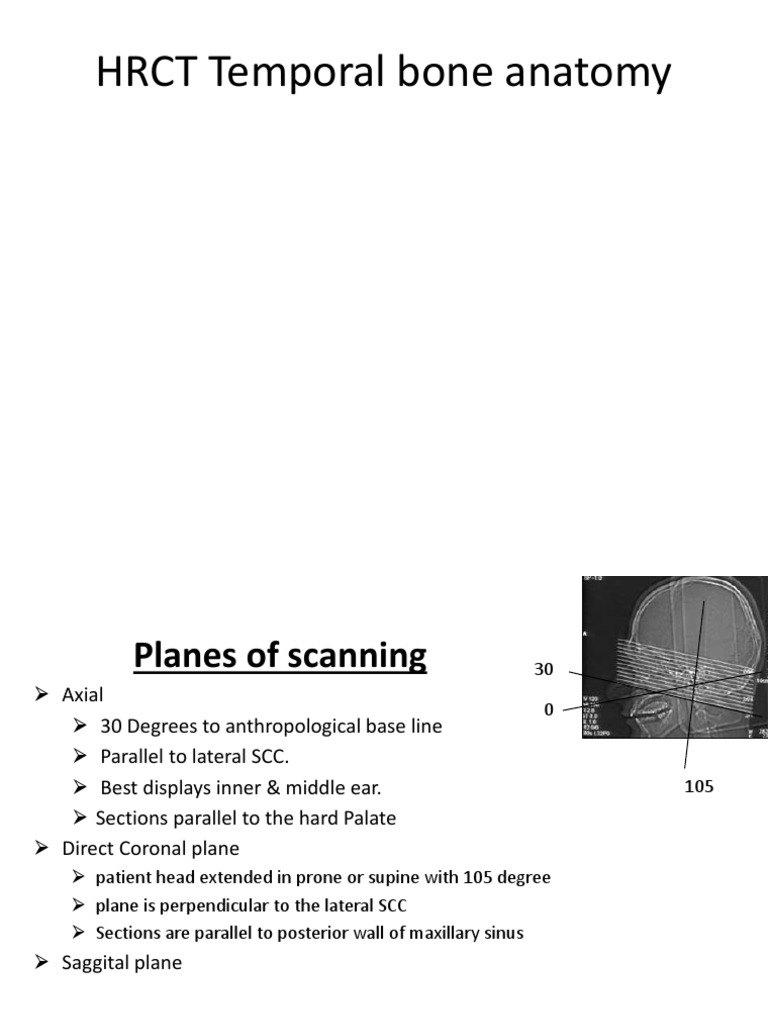 HRCT Temporal Bone Anatomy Overview | PDF | Ear | Auditory System