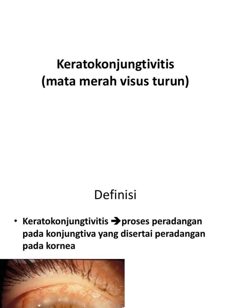 Keratokonjungtivitis Virda | PDF