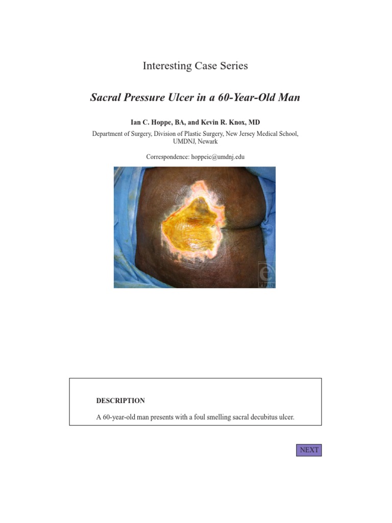 Sacral Pressure Ulcer in A 60-Year-Old Man: Interesting Case Series ...